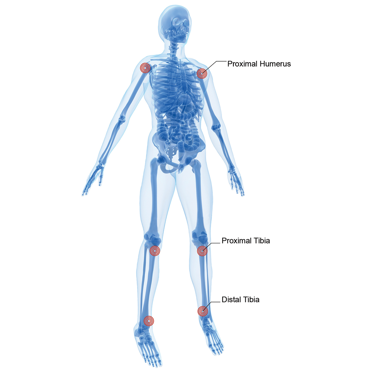 Arrow EZ IO Manual Needle Set Intraosseous Access Vascular Access arrow-ez-io-manual-needle-set-intraosseous-access-vascular-access